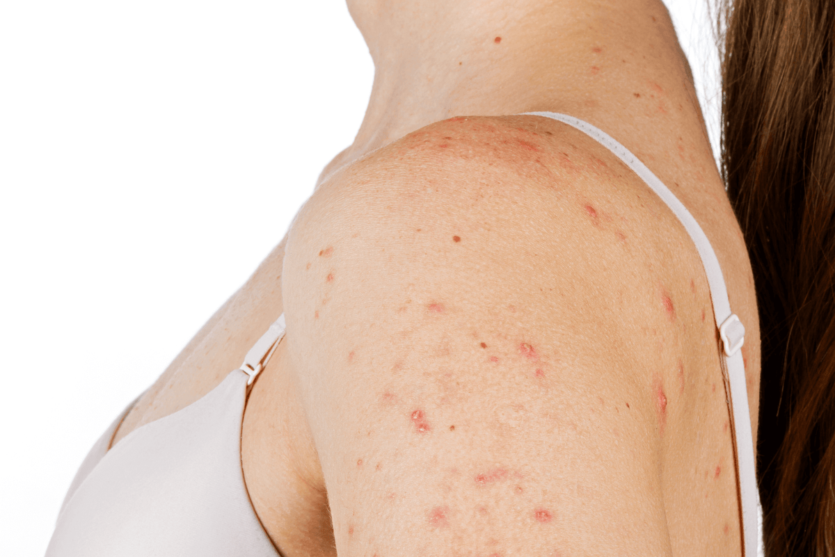 Shoulder Acne: Everything You Need to Know – Luminance RED