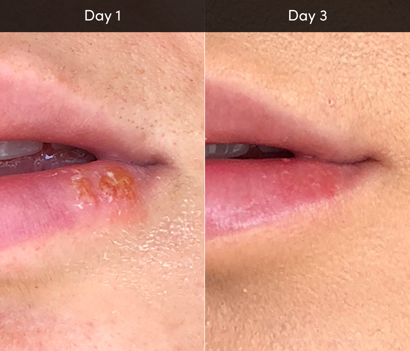 Lip Sore Treatment Device (Landing Page) – Luminance RED